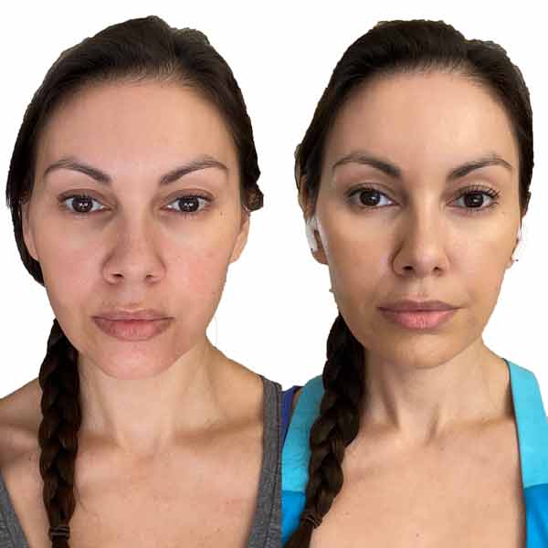 Chin Filler For Acne Scars Marionette Lines Jowls And More